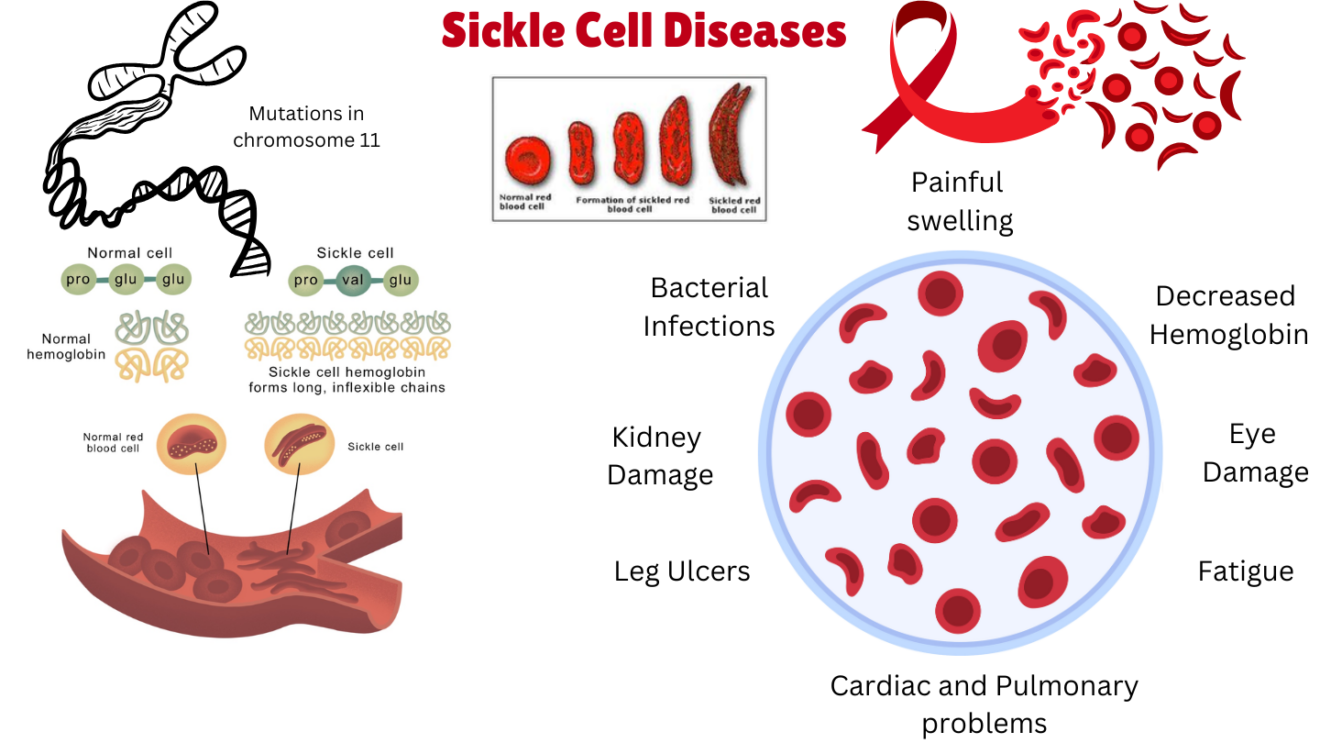 S for Sickle Cell Disease: Part I – MedNess